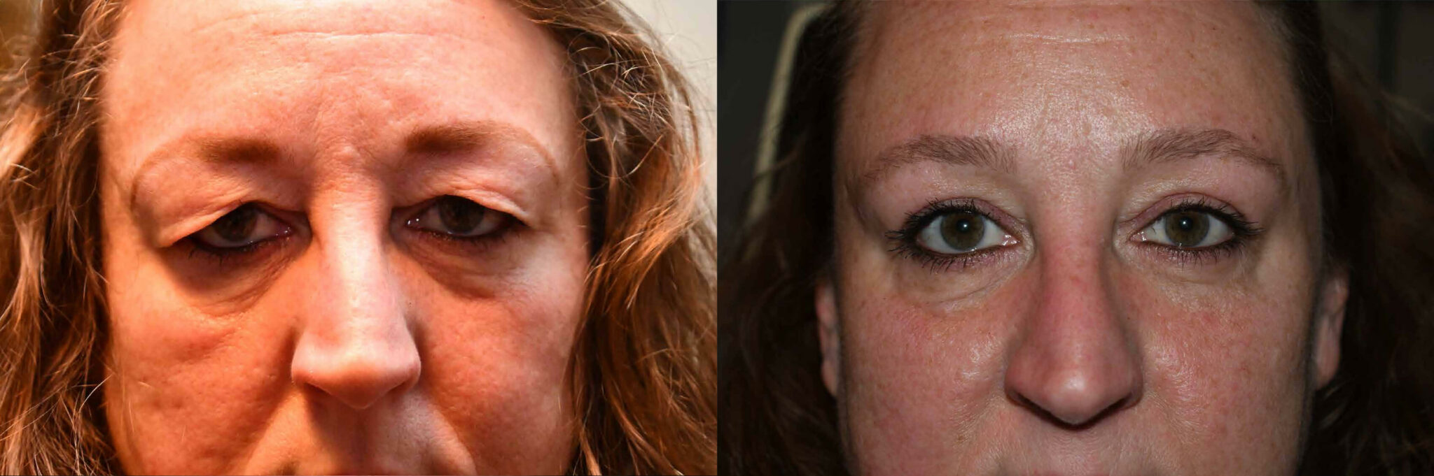 Before & After Photos | Eye Health Northwest