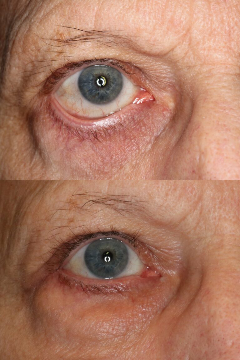 Blepharoplasty Portland | Eyelid Surgery Portland | EHNPC