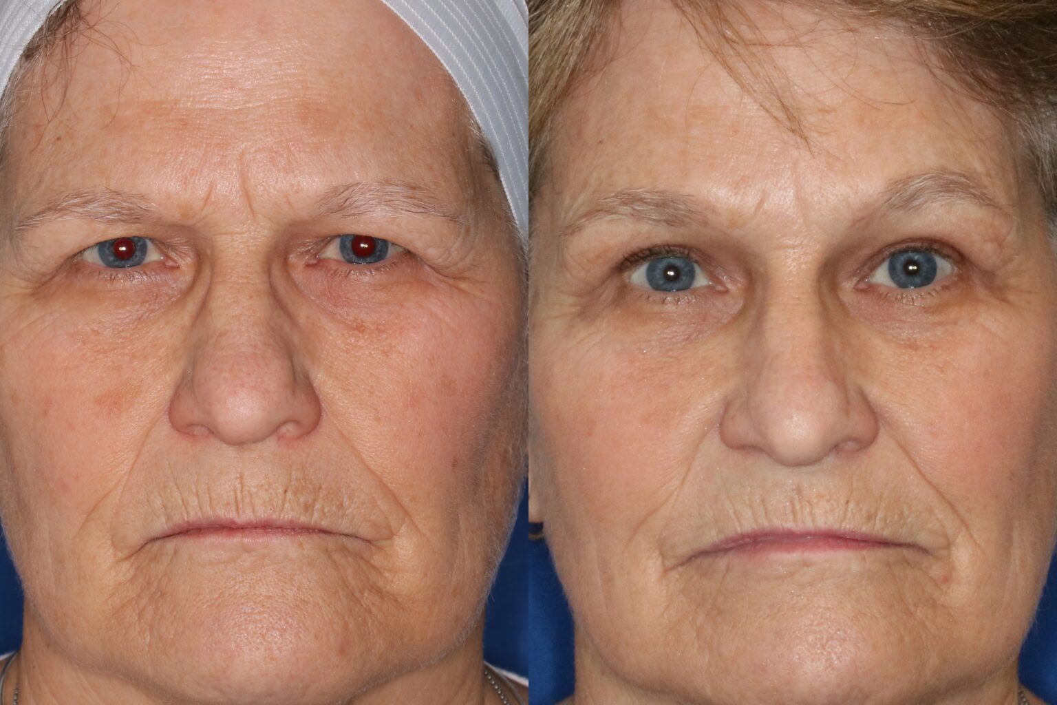 Before & After Photos | Eye Health Northwest