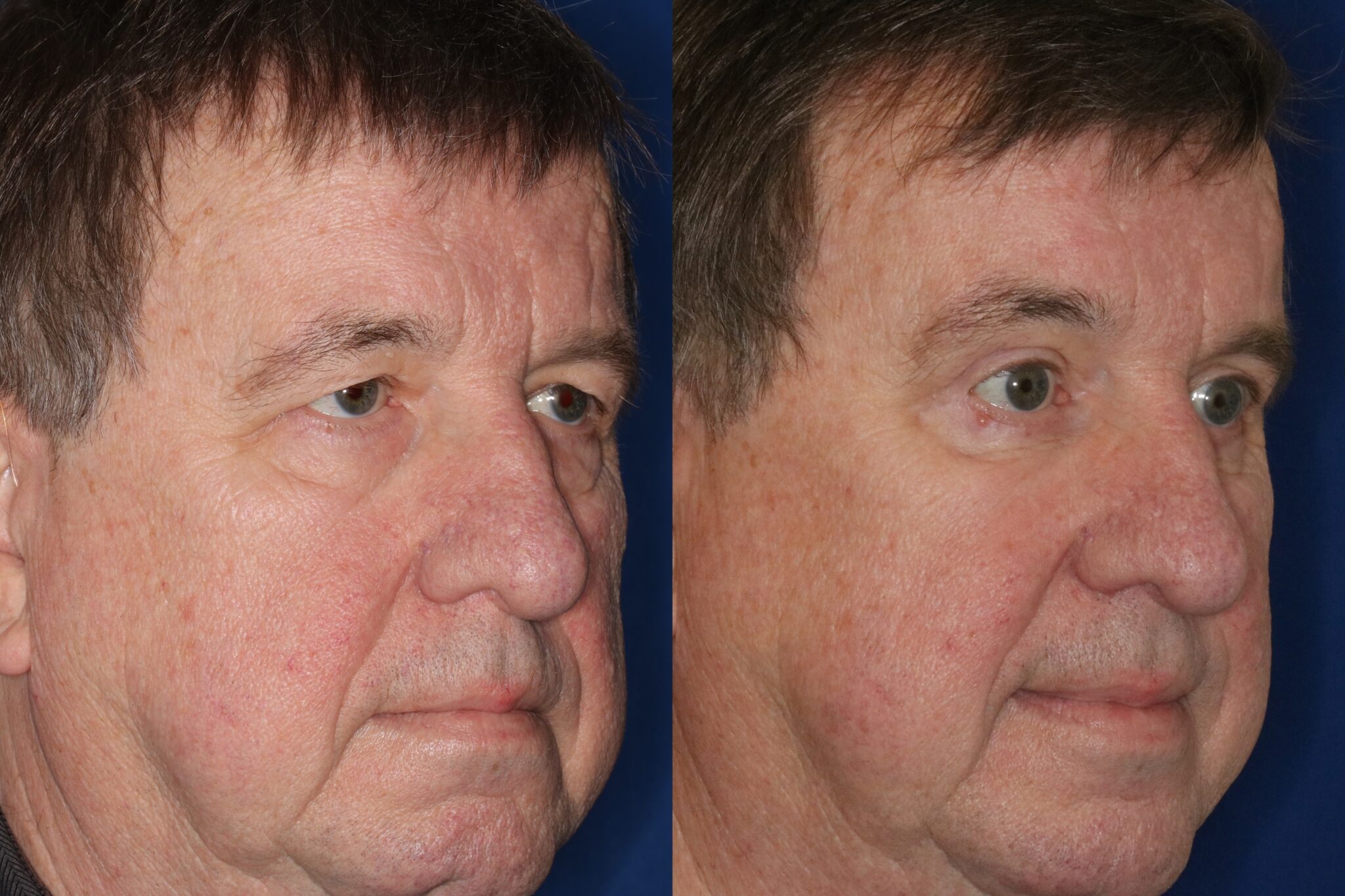 Before & After Photos | Eye Health Northwest