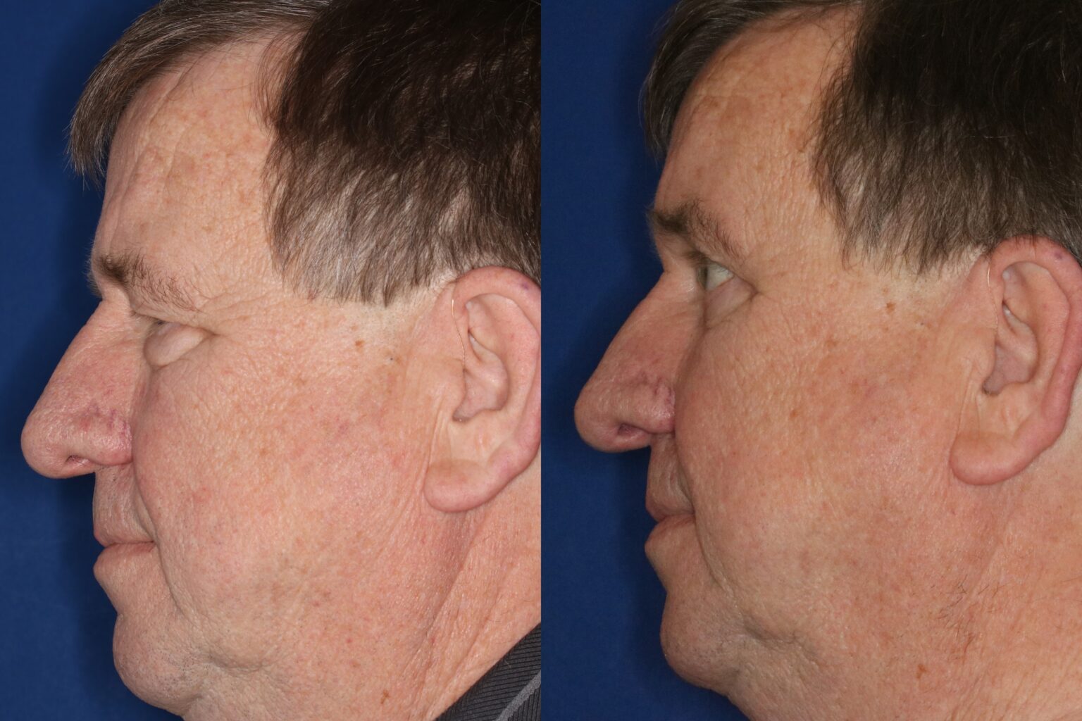 Before & After Photos | Eye Health Northwest