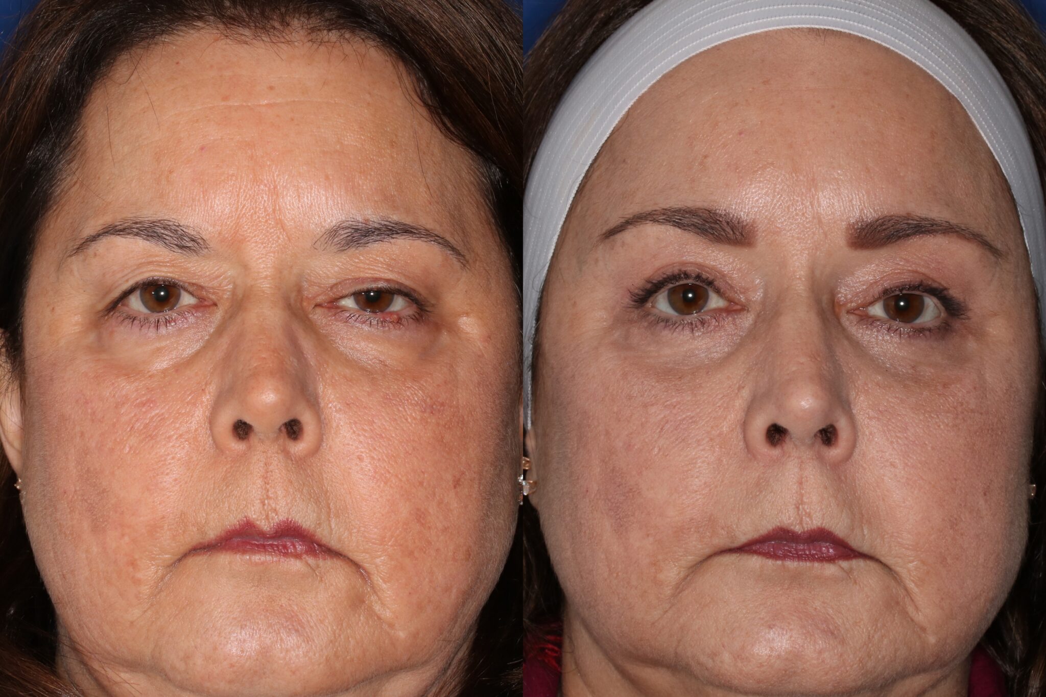 Before & After Photos | Eye Health Northwest