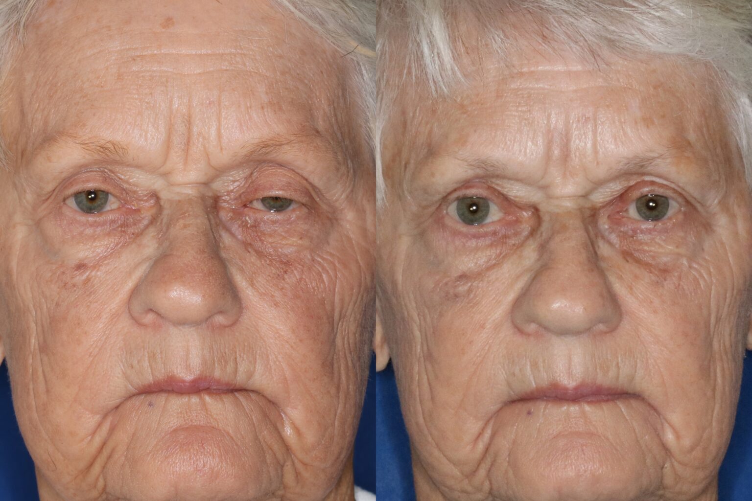 Before & After Photos | Eye Health Northwest