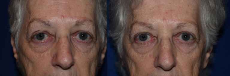 Blepharoplasty Portland | Eyelid Surgery Portland | EHNPC